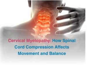 Cervical Myelopathy: How Spinal Cord Compression Affects Movement and ...